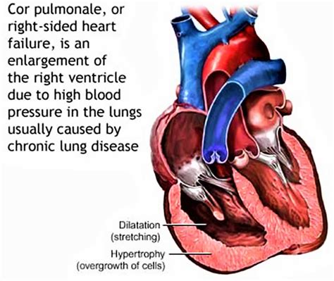 Other Pulmonary Embolism With Acute Cor Pulmonale Ecgzce