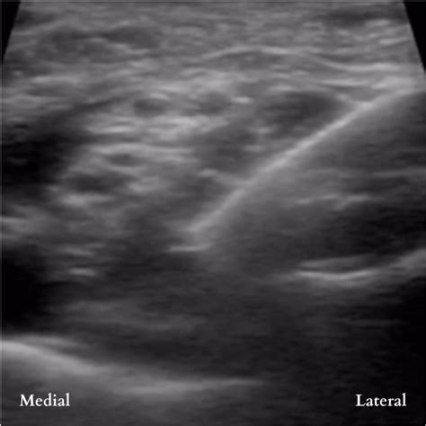 Ultrasoundguided Supraclavicular Brachial Plexus Block