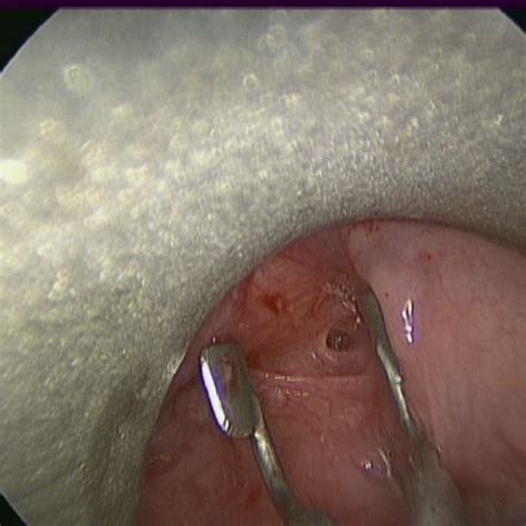 Internal Opening Over Left Pyriform Fossa After Diathermised Download