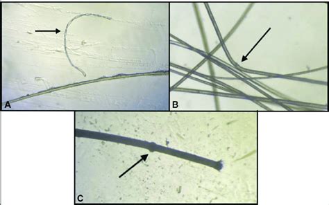 Photomicrographs Of Hair On Routine Light Microscopy A Pili Torti