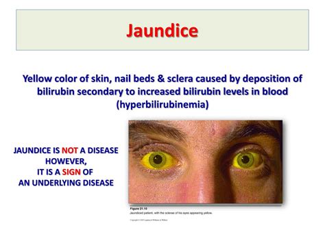 Ppt Bilirubin Metabolism And Jaundice Powerpoint Presentation Free