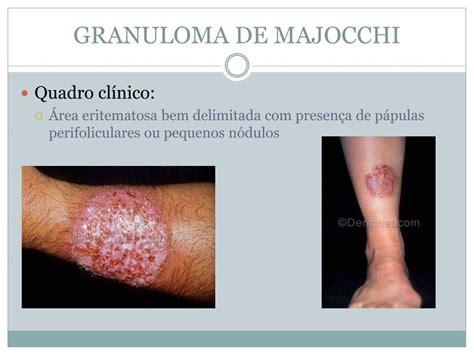 Ppt Dermatofitoses Powerpoint Presentation Free Download Id 5791555