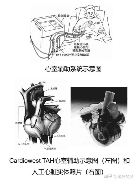 为什么ecmo的使用费用那么高？ 知乎