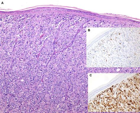 Distant Cutaneous Metastases Of Prostate Cancer A Report Of 2 Cases