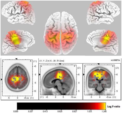 Loreta Eeg Source Localization Factory Sale