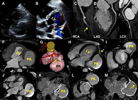 Frontiers Case Report A Left Ventricular Pseudoaneurysm Detected By