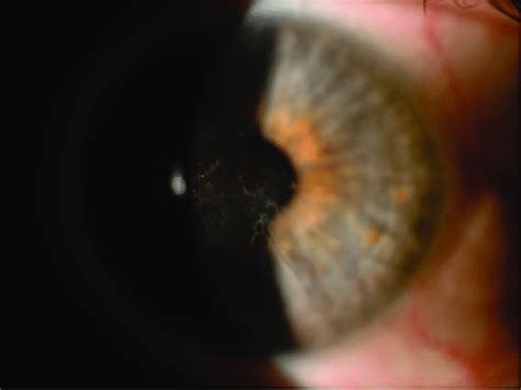 Subepithelial Fibrosis Is Visualized In The Optical Center Of The Cornea Download Scientific