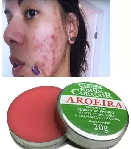 Pomada Aroeira Para Cravos Espinhas Tira Mancha De Espinhas MercadoLivre