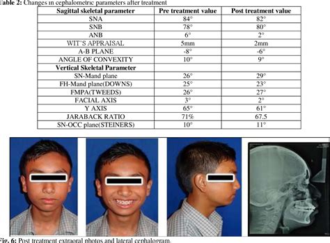 Table 1 From A Case Report On Treatment Of Class Ii Jaw Discrepancy With Dental Crowding With