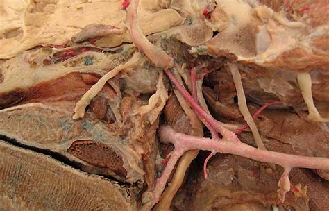 Glossopharyngeal Nerve Cadaver