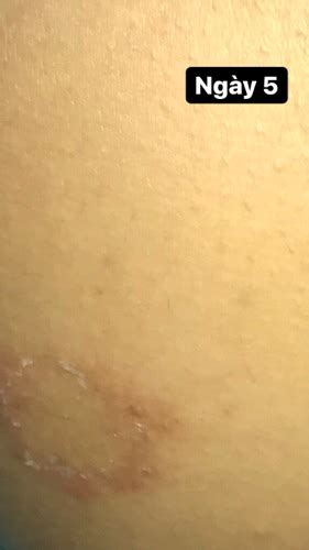 Em B N I Ng A Sau V Ng Da M Ng V T Nh Tr Ng C Ng Y C C