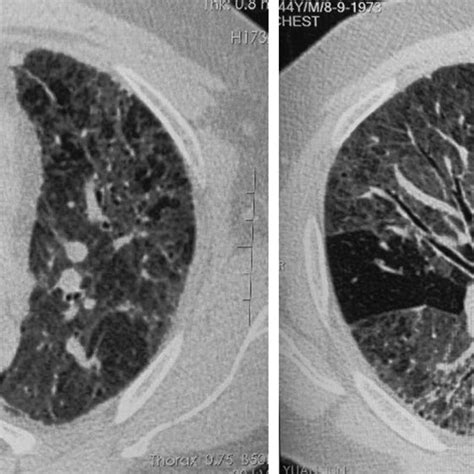 High Resolution Ct Reveals Diffuse Lesions In Both Lungs With Visible Download Scientific