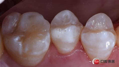 隐藏的龋洞——右上第二前磨牙树脂充填 林永顺的博客 Kq88口腔博客