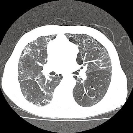 High Resolution Computed Tomography Showing Bilateral Diffuse Pulmonary Download Scientific
