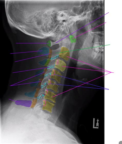 Diagram Of X Ray C Spine Lateral Projection Quizlet