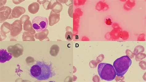 Microscopic Picture Of Bone Marrow Smear A Nuclear Hyposegmentation