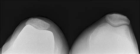 Patellar Maltracking With A Lateral Osteophyte And Increased Tilt In A Download Scientific