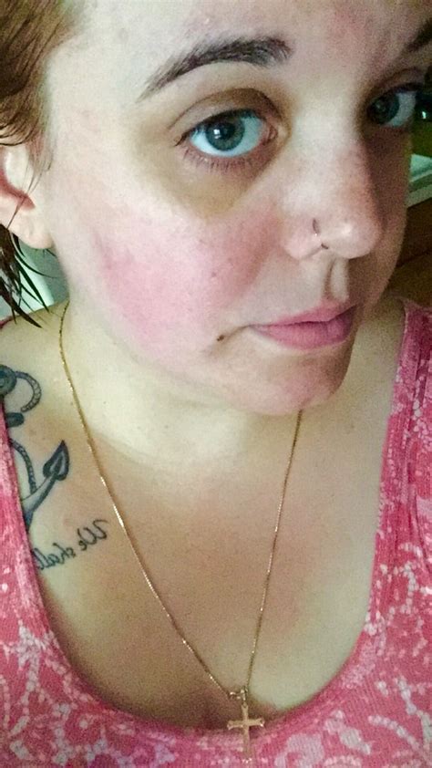 16 Photos That Show How Fibromyalgia Can Affect Your Skin Artofit