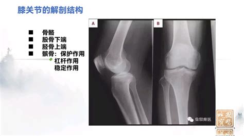 膝骨关节炎的定义解剖及生物力线 健康160