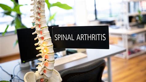 Arthritis In Spine Causes Symptoms And Treatment Options Eric Tsai