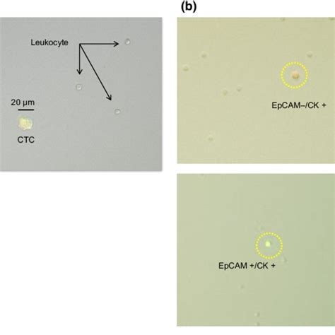 Isolated Circulating Tumor Cell Ctc With A Few Leukocytes A The