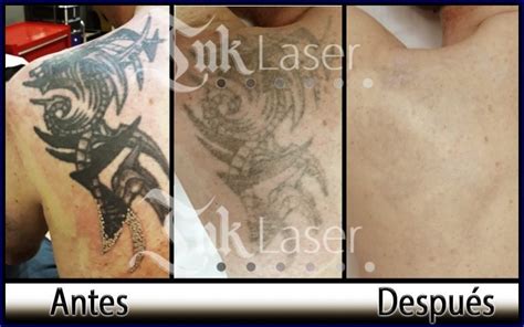 Eliminar tatuajes Alicante Quitar Borrar tatuajes Ink Láser