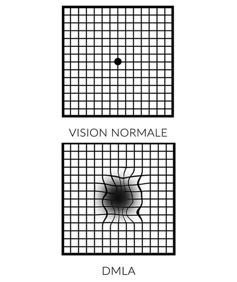 Baisse De La Vue Causes Et Solutions