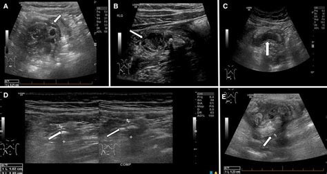 Normal Appendix Ultrasound