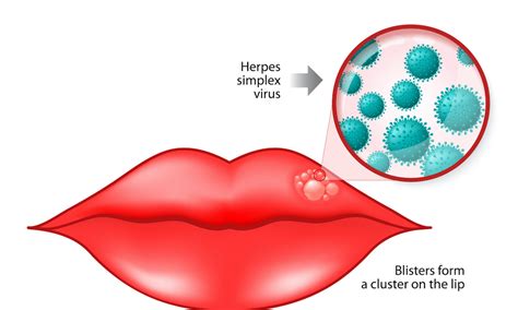 Cold Sore In Nose
