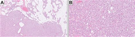 Chief Cell Parathyroid Adenoma Ab Parathyroid Adenoma Composed
