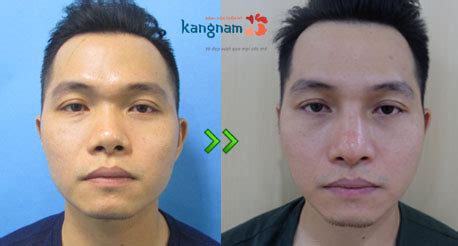 Mũi tẹt là như thế nào Sống mũi tẹt hếch phải làm sao để khắc phục