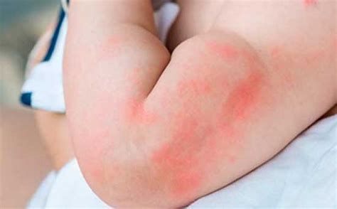 Como Tratar La Dermatitis Atópica Con Sensyderm Bassa Ecuador Bassa