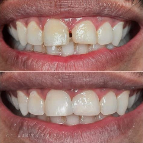 Dental Gap Closure Diastema Treatment