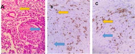 expression of cd4 and cd8 based on ihc cell count analysis in poorly