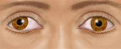 Sensory Exotropia Optography