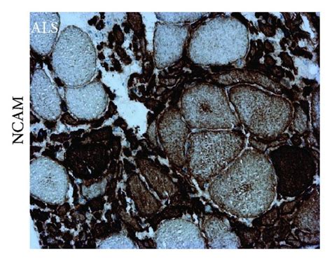 Ncam In Als A Ncam Mrna Transcript In Als During Disease Progression