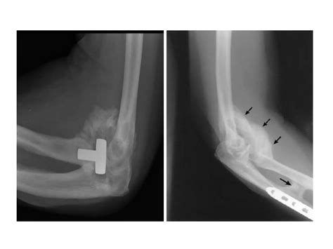 Complications Of Fructure In Orthopaedic Ppt