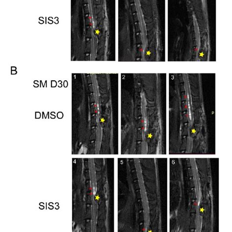 Some Ependymal Cells Were Dispeared Along Central Canal A Ependymal