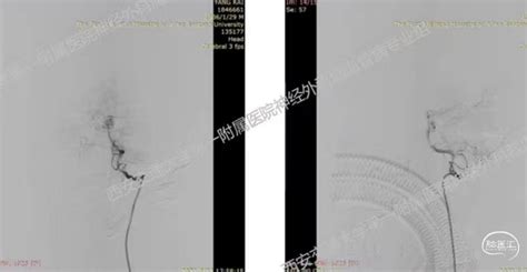 谢万福教授团队：血流导向装置 Pipeline Flex 治疗基底动脉巨大夹层动脉瘤1例 脑医汇