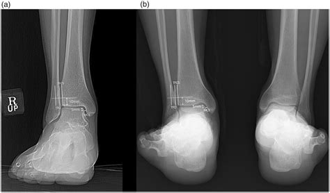 Measured Radiographic Parameters In The A Anteroposterior View And