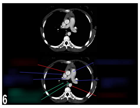 Diagram Of Ct Thorax Axial 6 Quizlet
