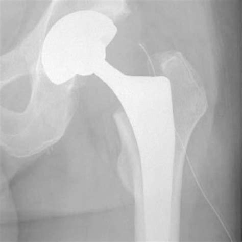 Cementless Thr Implantation Using The Quadra Femoral Stem Thr Total Download Scientific