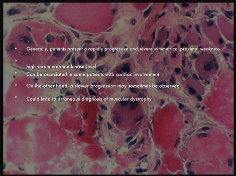 Necrotizing Myopathy By Brooke Lam