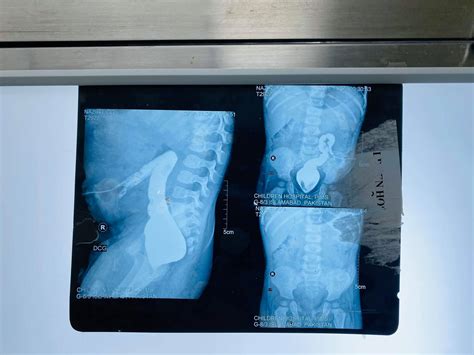 Prof Nadeem Akhtar Distal Loopogram Of Anorectal Malformation Patient Done Before Second