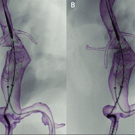 Patient Specific Rehearsal Of EVAR For A Ruptured AAA On The Angio