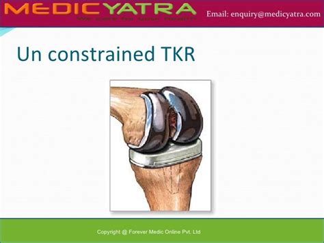 Total Knee Replacement Tkr Surgery