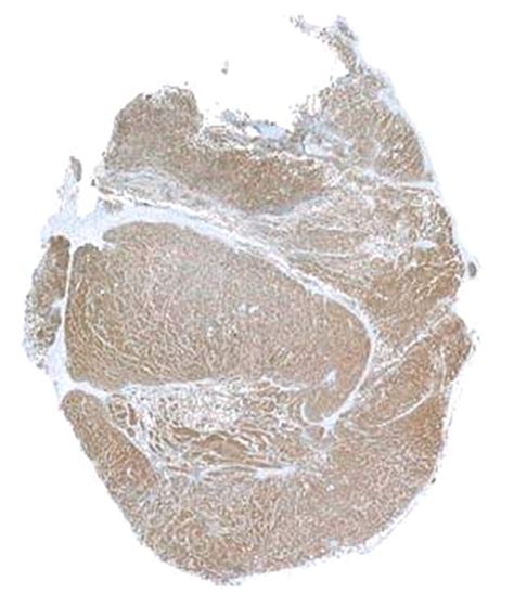 Radiologic Findings Of Peripheral Primitive Neuroectodermal Tumor Arising In The Retroperitoneum