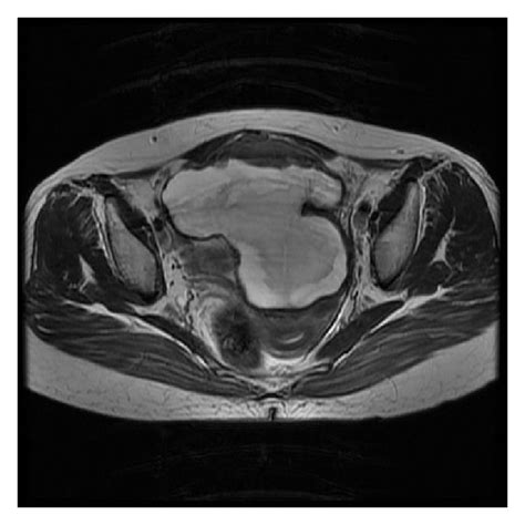 Magnetic Resonance Imaging Of The Pelvis Lobulated Masses In The