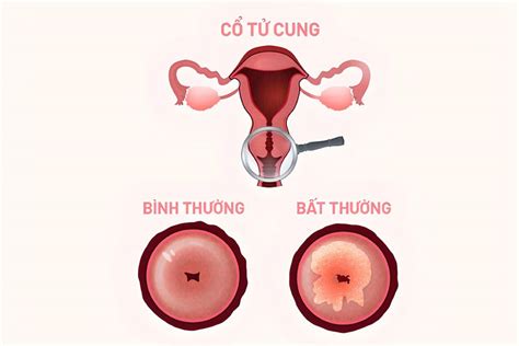 Nữ giới bị viêm cổ tử cung có thai được không