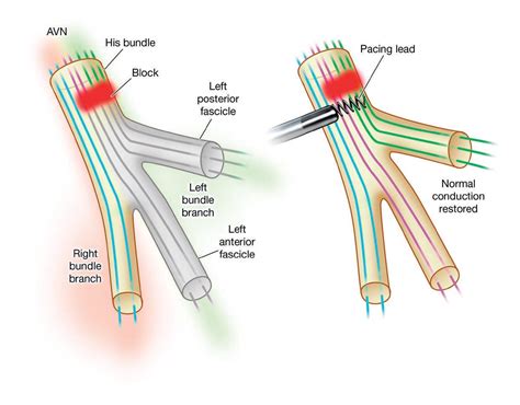 Left Bundle Branch And Conduction System Pacing Dr Ravninder Singh Kuka